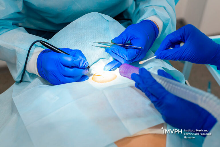 Qué es Fulguración de condilomas y verrugas genitales - IMVPH
