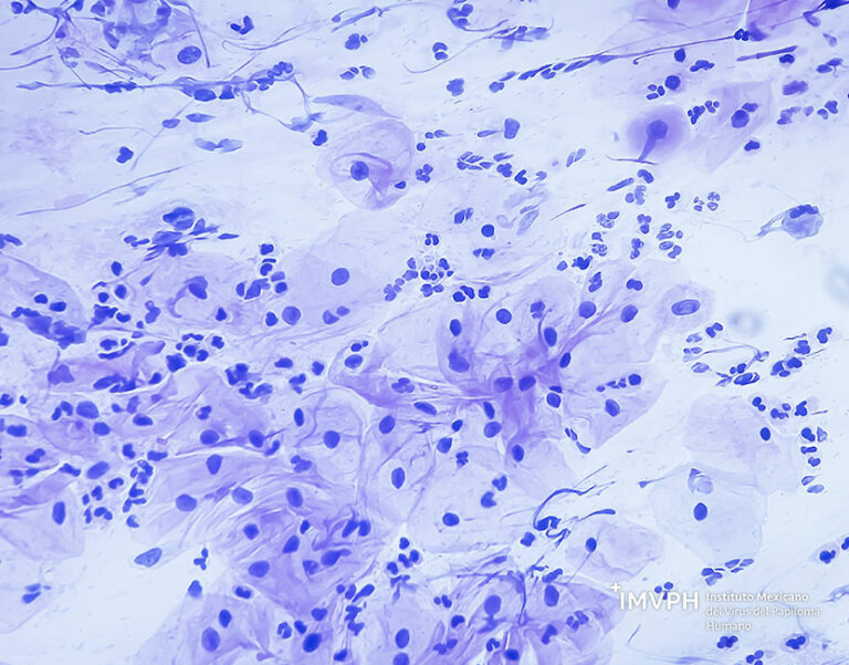 Qué tipos de VPH detecta la prueba PCR - IMVPH