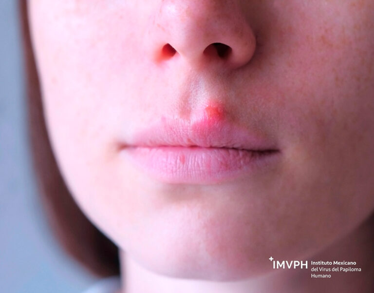 ¿Cómo empiezan a salir las verrugas del VPH en la boca?